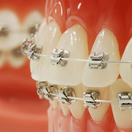 Brackets & Bondable Attachments Archives - ORTHOMAX Australia