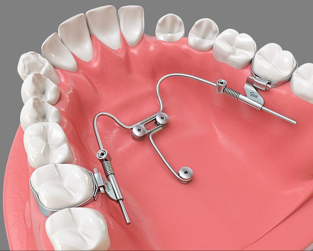 BENEFIT PALATAL TADS - ORTHOMAX Australia
