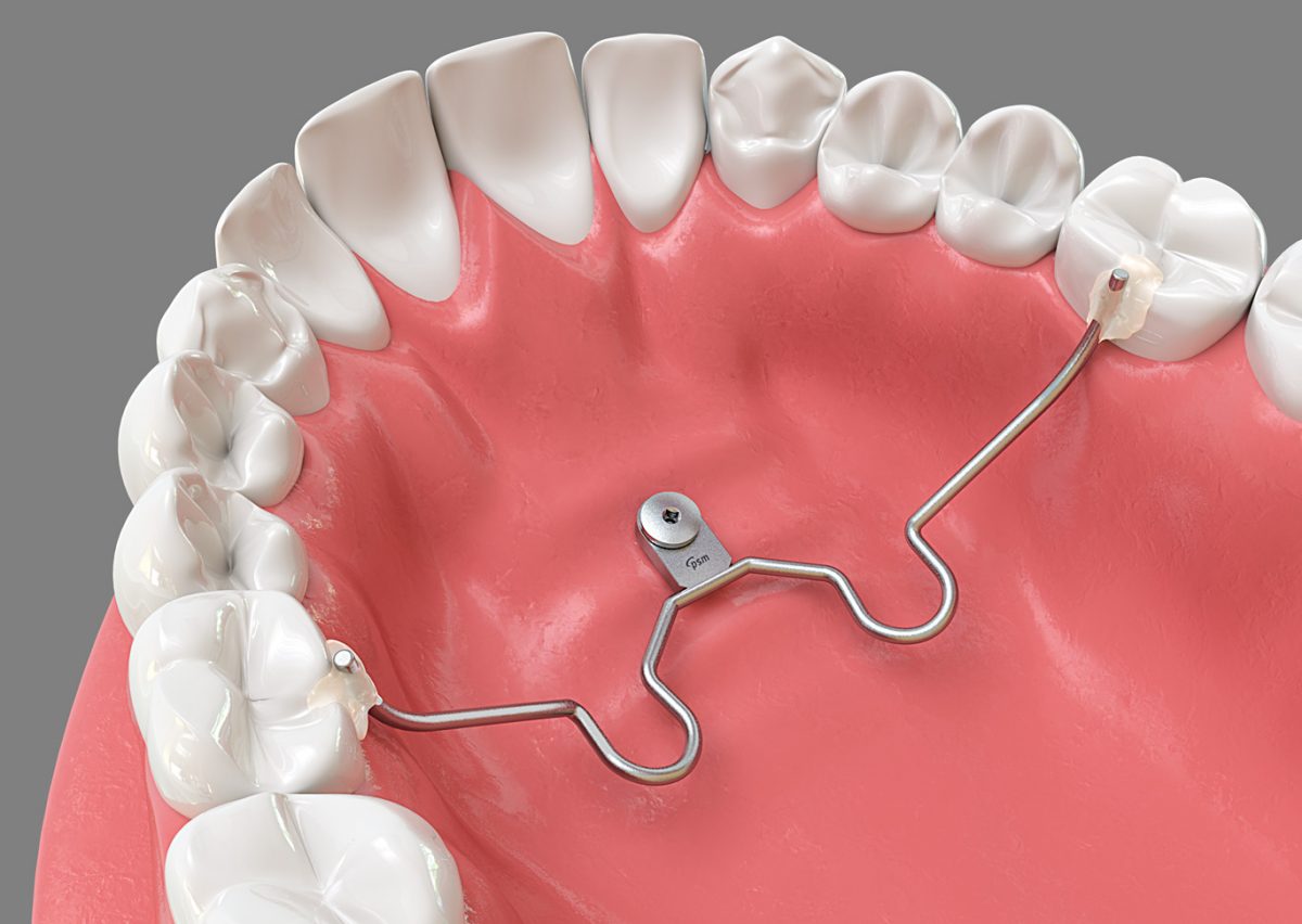 BENEFIT PALATAL TADS - ORTHOMAX Australia