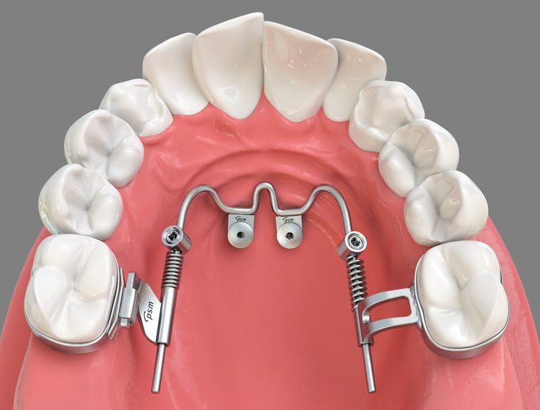 BENEFIT PALATAL TADS - ORTHOMAX Australia