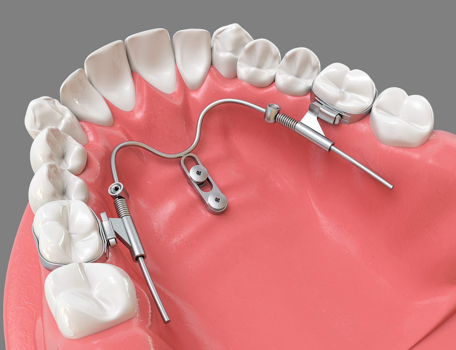 BENEFIT PALATAL TADS - ORTHOMAX Australia