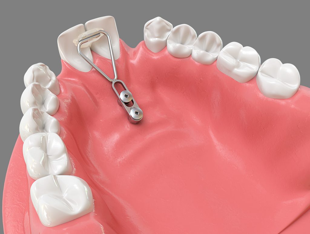BENEFIT PALATAL TADS - ORTHOMAX Australia