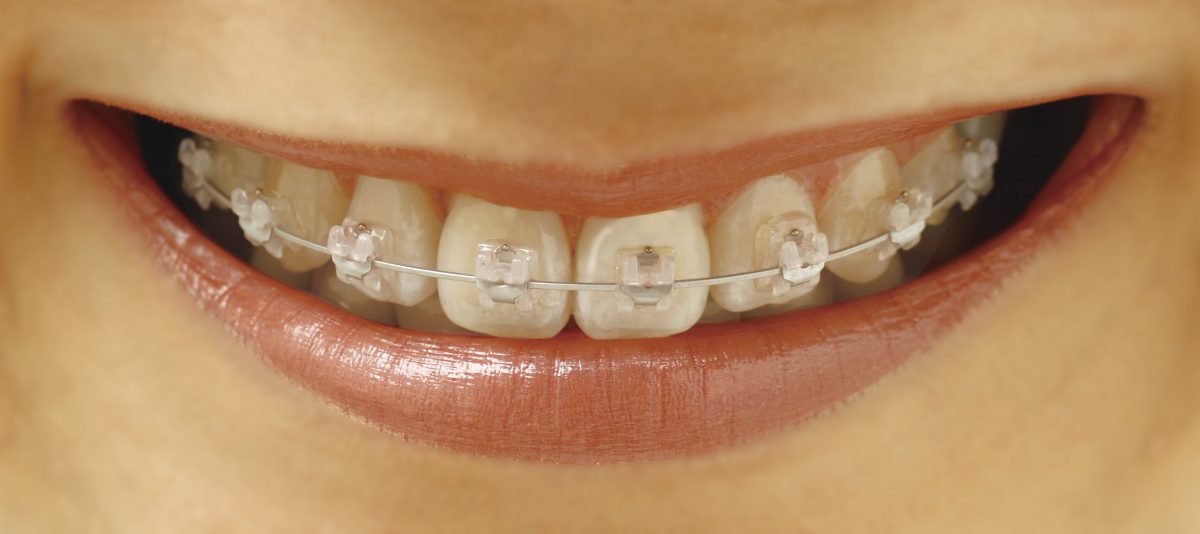 CLIPPY C 2G CERAMIC SL BRACKETS - ORTHOMAX Australia