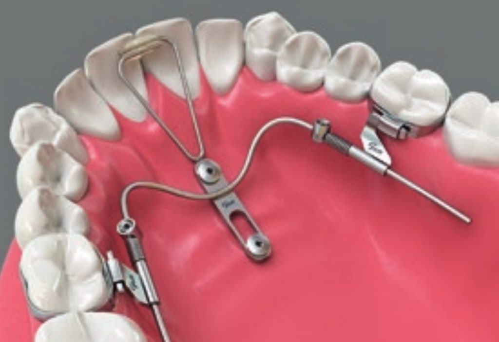 BENEPLATES - ORTHOMAX Australia