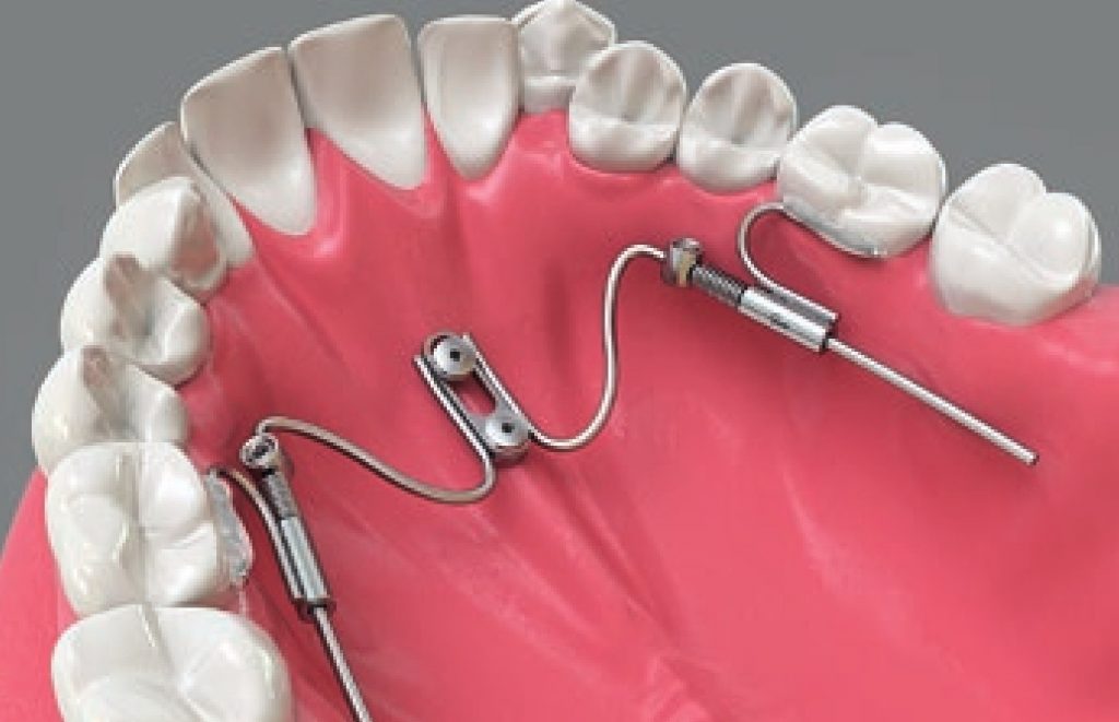 BENEPLATES - ORTHOMAX Australia